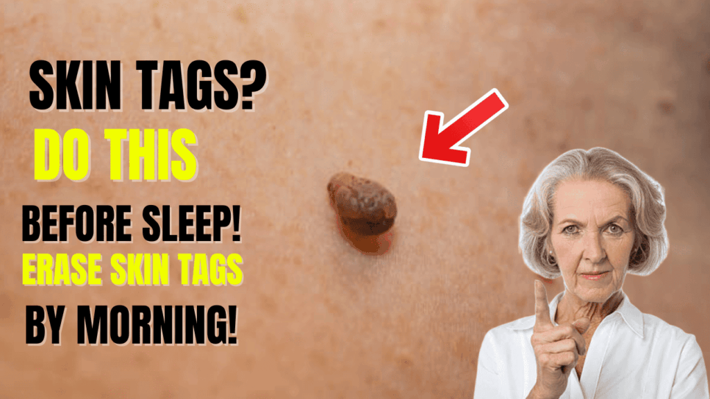 This Weird Trick Removes Skin Tags Overnight (So Simple!)